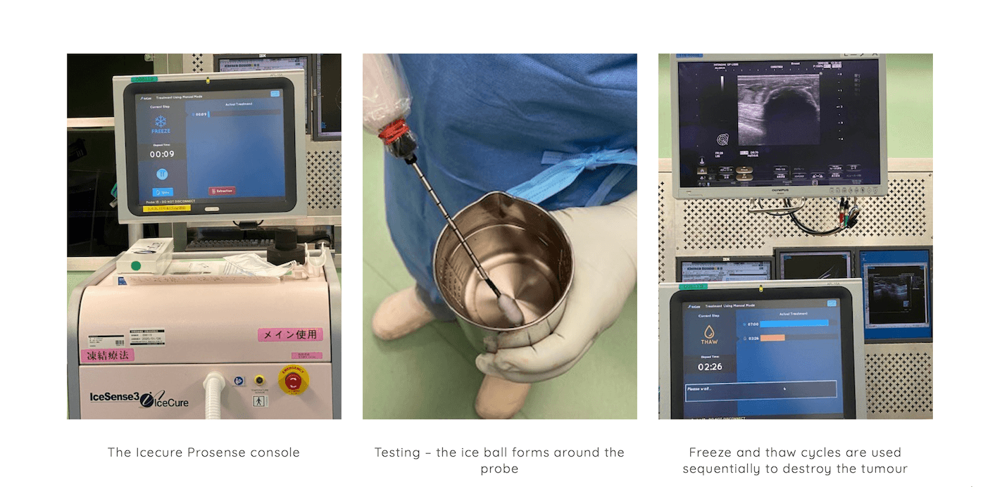 Cryoablation - Parklane Radiology Centre of Excellence